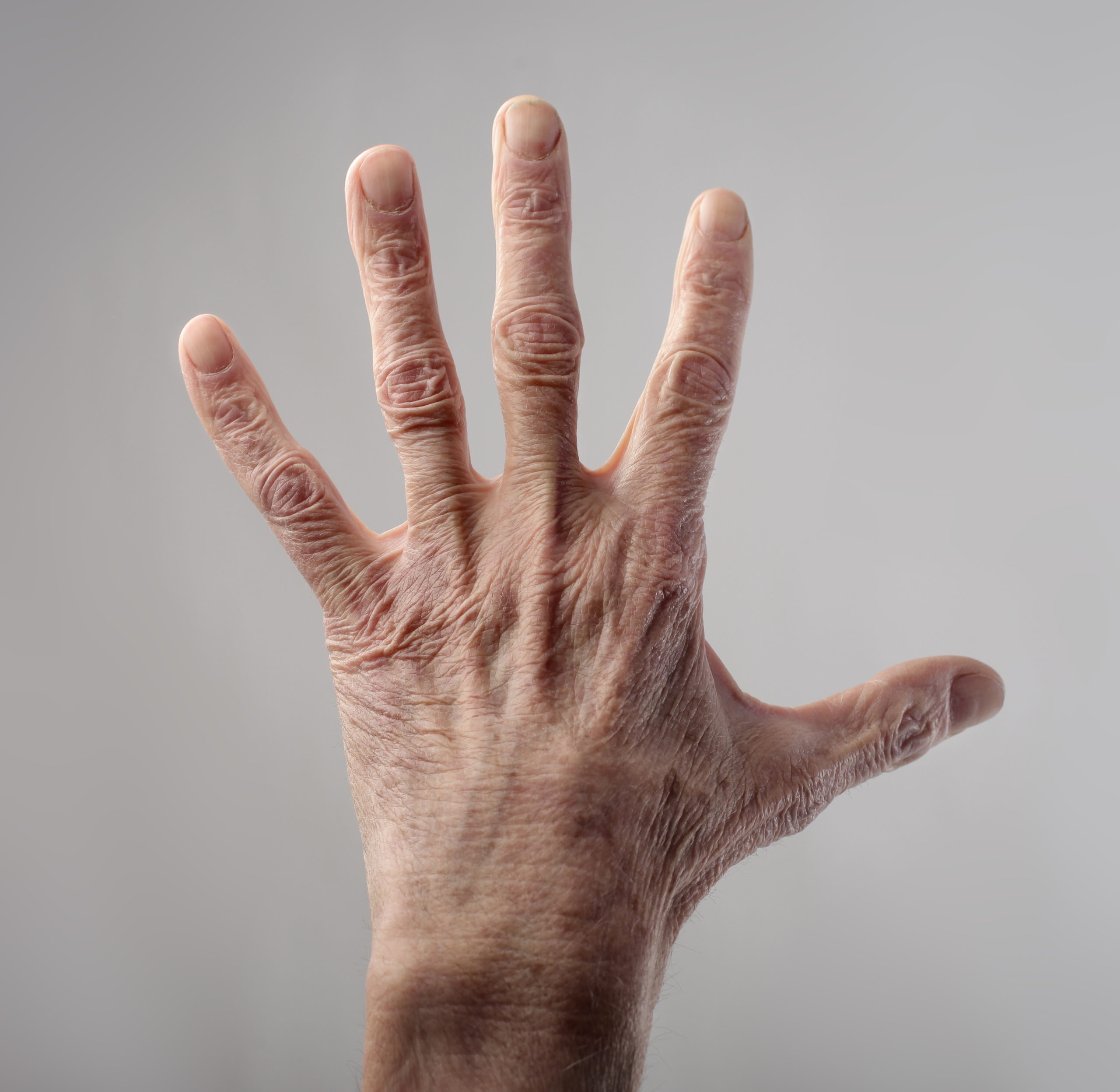 What can we do about ageing hands? - Hampton Clinic